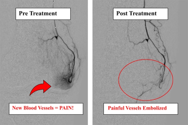 Genicular Artery Embolization (GAE) for Arthritis Knee Pain - Michigan ...